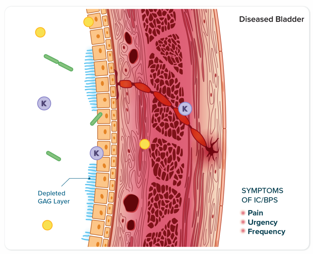 IC/BPS - Vaneltix Pharma
